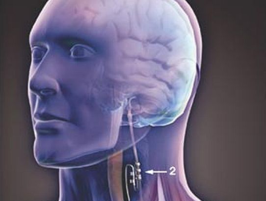 New neck nerve stimulation device could cut heart failure symptoms ...